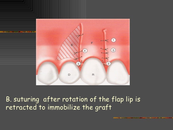 Lateral pedical graft
