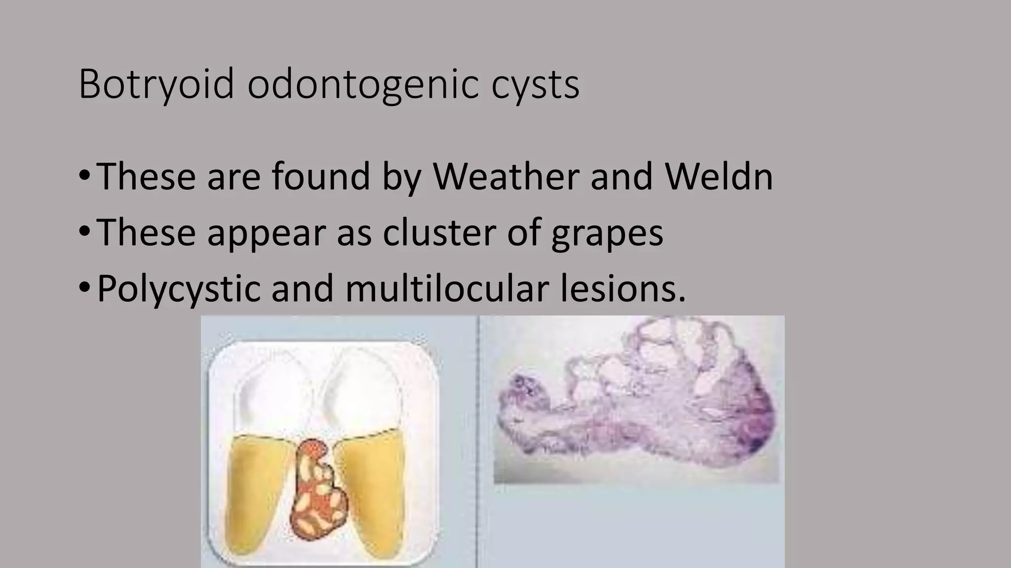 Lateral periodontal cyst | PPTX