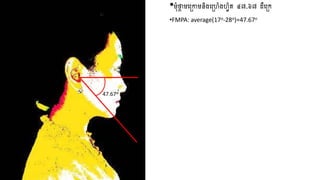 Lateral profile measurement | PPT