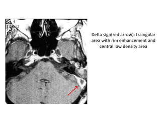 Lateral sinus thrombophlebitis | PPTX