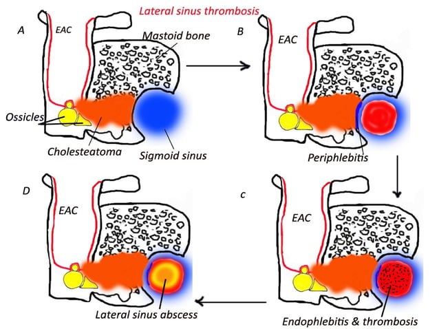 Lateral sinus thrombosis | PPT