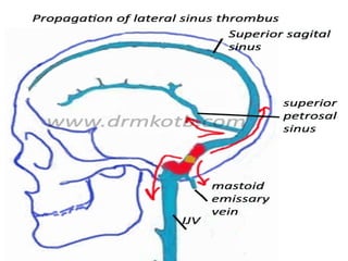 Lateral sinus thrombosis | PPT