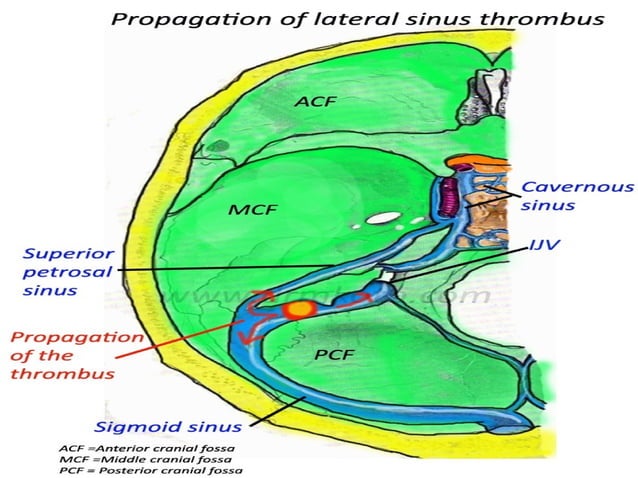 Lateral sinus thrombosis | PPT