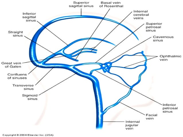 Lateral sinus thrombosis | PPT