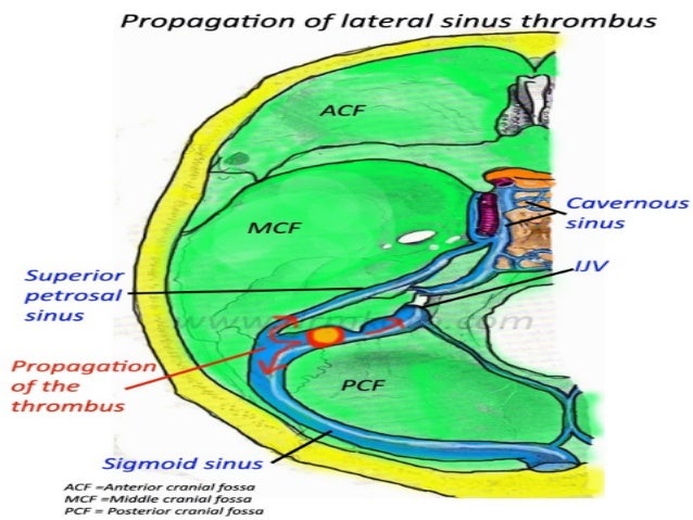 Lateral sinus thrombosis