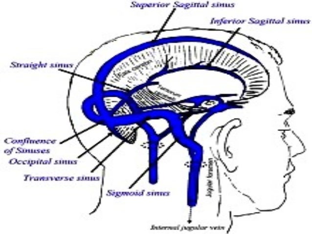 Lateral sinus thrombosis