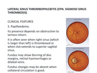 Complication of CSOM - Lateral Sinus Thrombosis | PPTX
