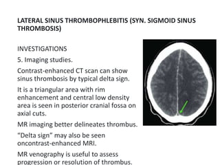 Complication of CSOM - Lateral Sinus Thrombosis | PPTX