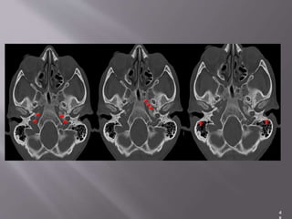 Lateral skull base anatomy and applied science by Dr, bomkar bam | PPTX