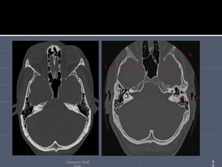 Lateral skull base anatomy and applied science by Dr, bomkar bam | PPTX
