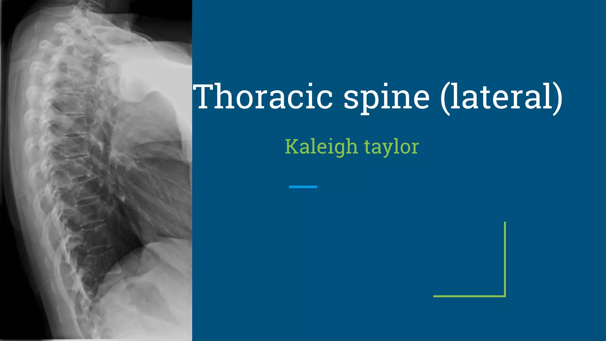 Lateral t spine kaleigh | PPTX
