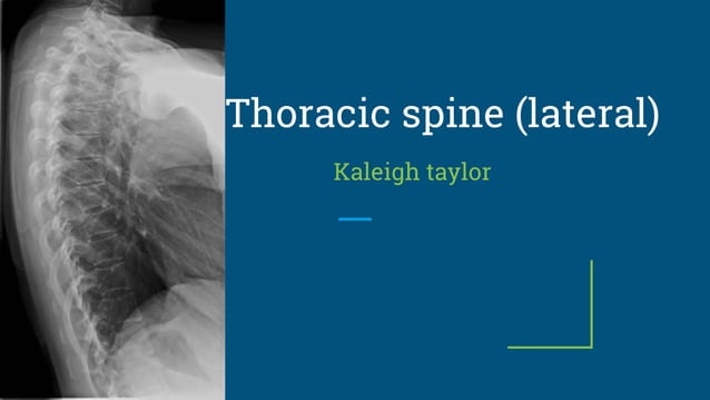 Lateral t spine kaleigh | PPTX | Eye and Vision Conditions | Diseases ...