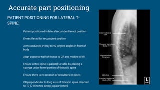 Lateral t spine kaleigh | PPTX