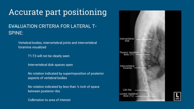 Lateral t spine kaleigh | PPTX | Eye and Vision Conditions | Diseases ...