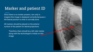 Lateral t spine kaleigh | PPTX