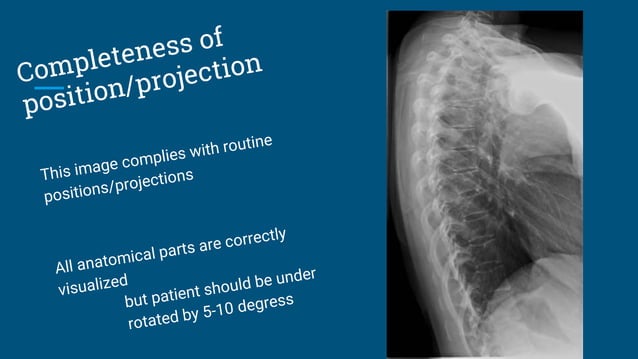 Lateral t spine kaleigh | PPTX | Eye and Vision Conditions | Diseases ...
