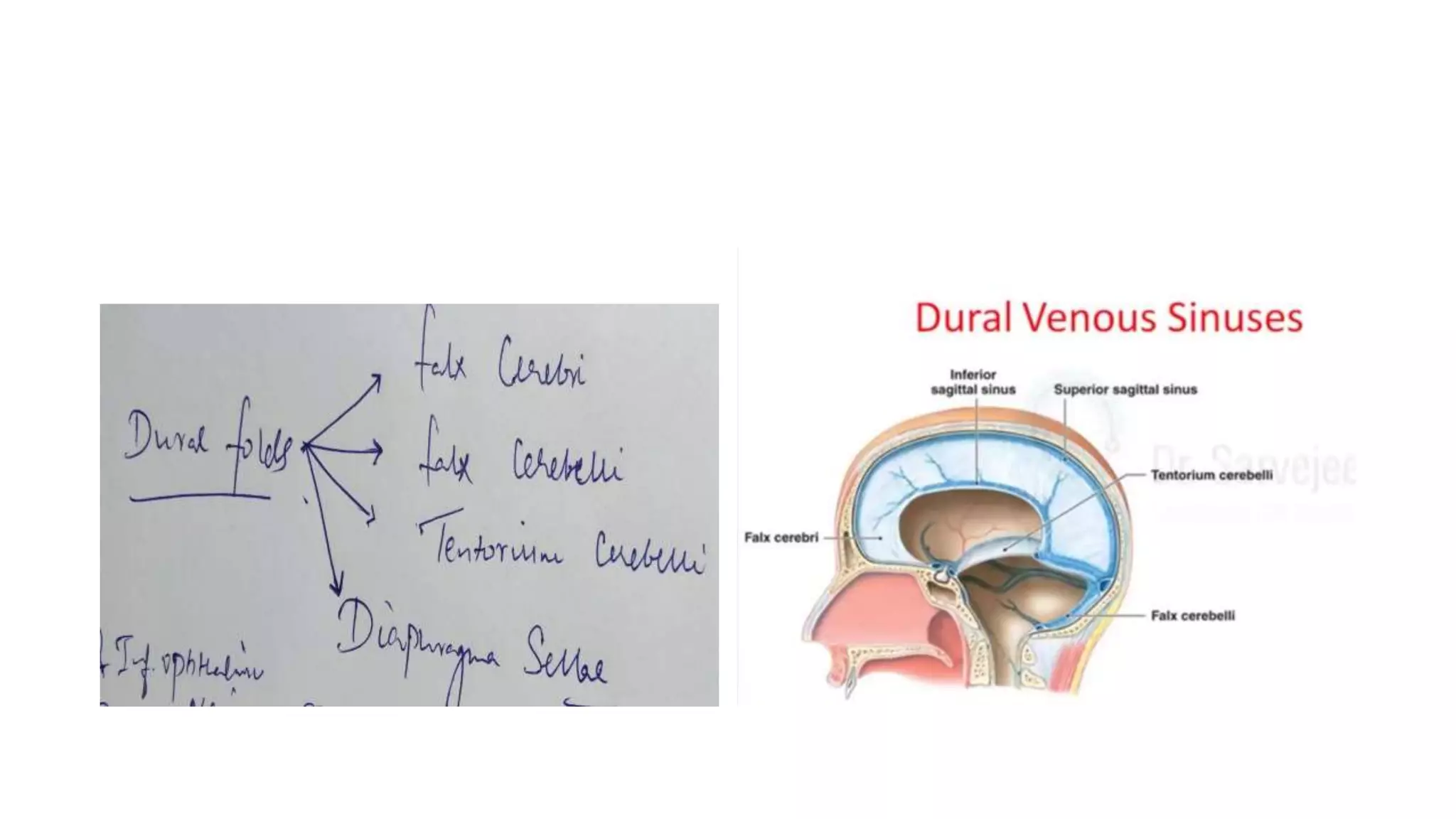 lateral venous sinus.pptx
