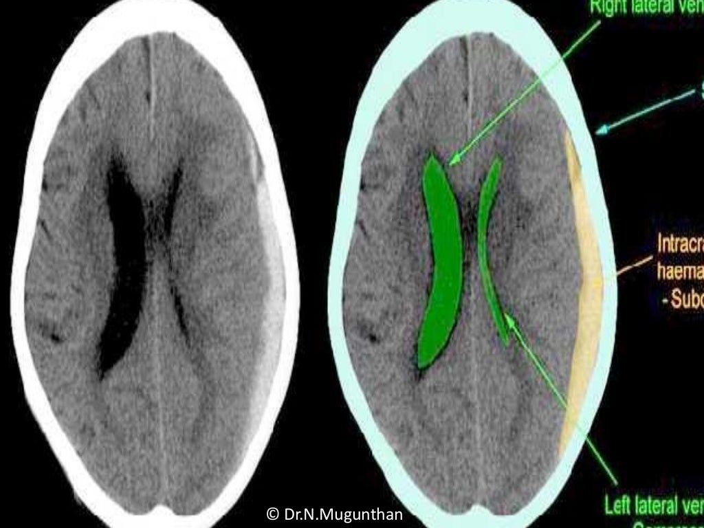 Lateral ventricle of Brain. By Dr.N.Mugunthan.M.S