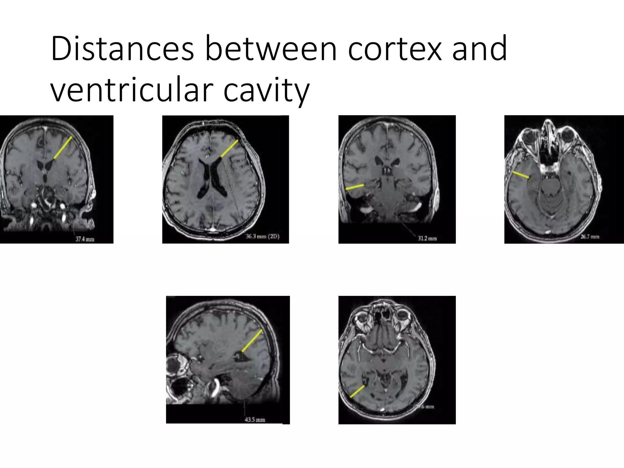 Lateral ventricle n copy | PPTX