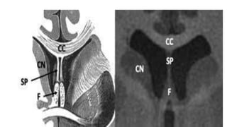 Lateral Ventricles.pdf very easy good diagrams comprehensive | PDF