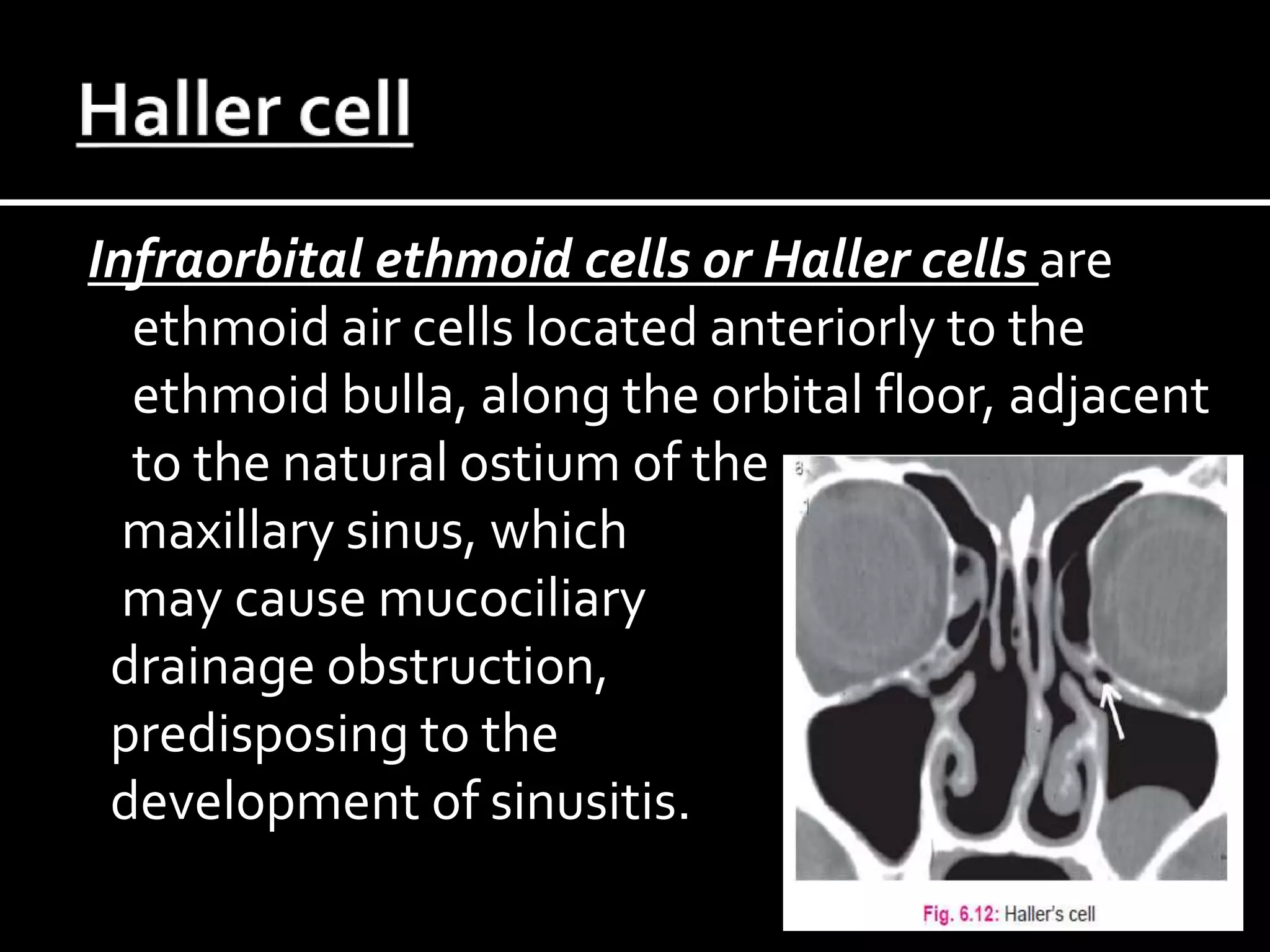 Anatomy of Lateral wall of nose | PPTX