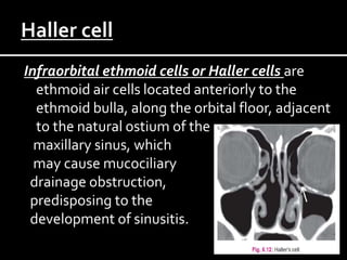 Anatomy of Lateral wall of nose | PPTX
