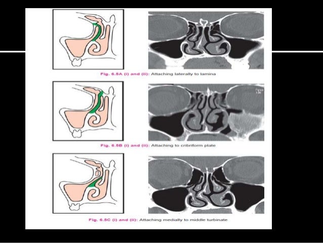 Anatomy of Lateral wall of nose