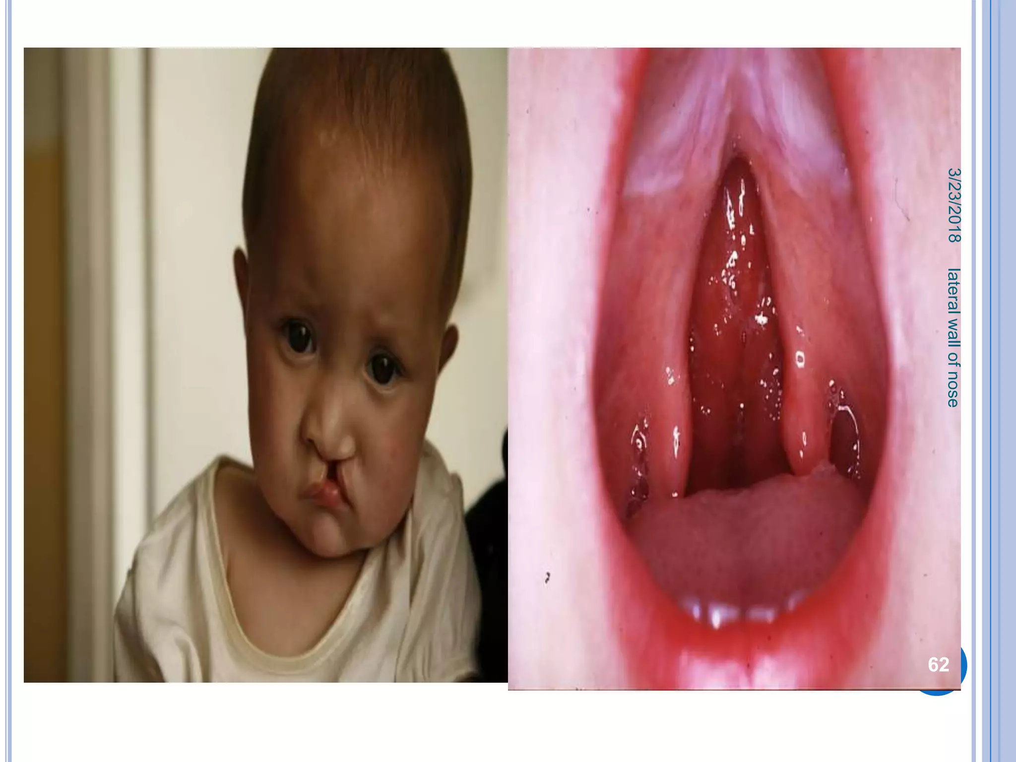 Lateral wall of nose | PPTX