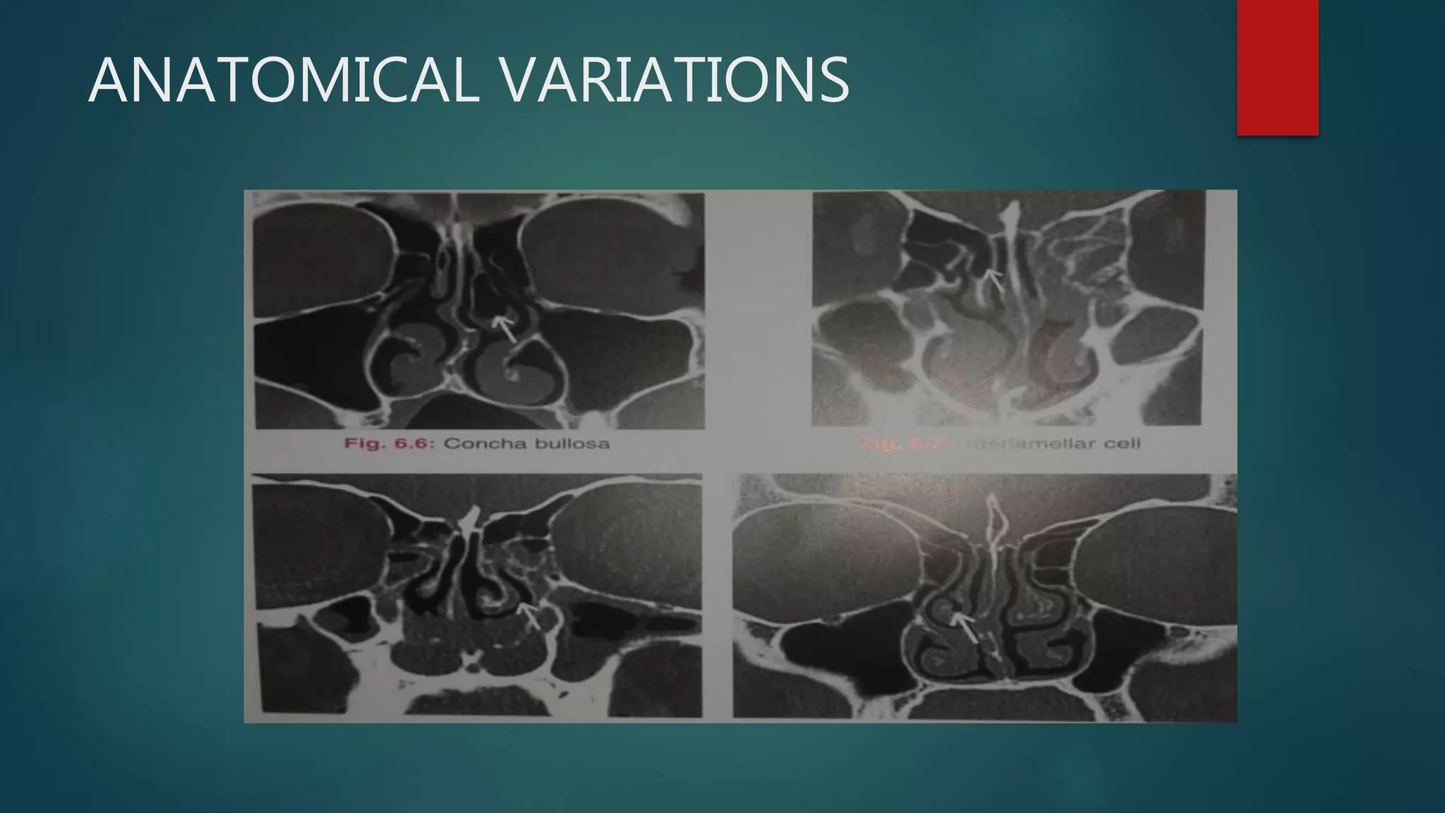 Anatomy of Internal Nose | PPTX