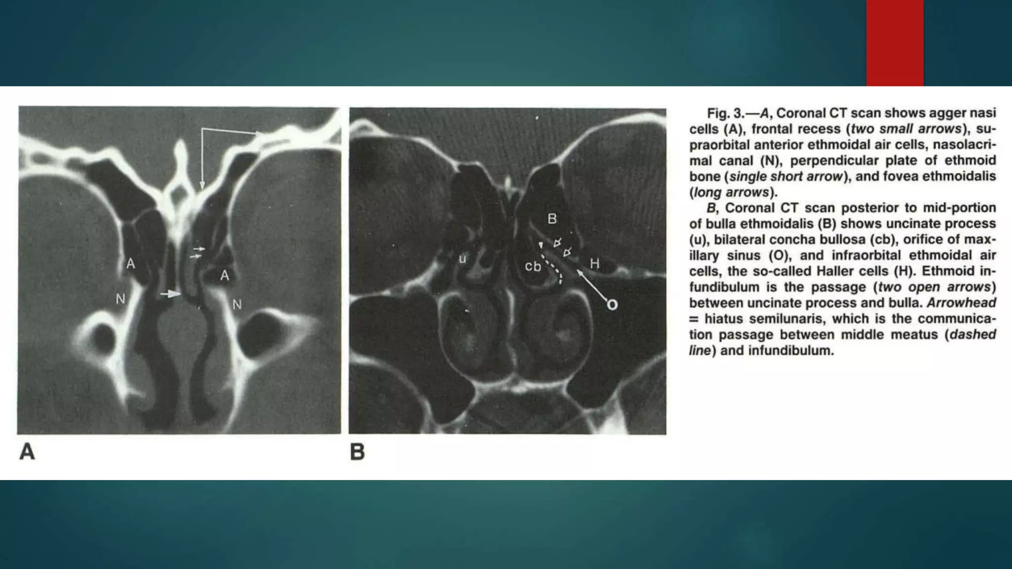 Anatomy of Internal Nose | PPTX