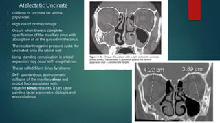Anatomy of Internal Nose | PPTX