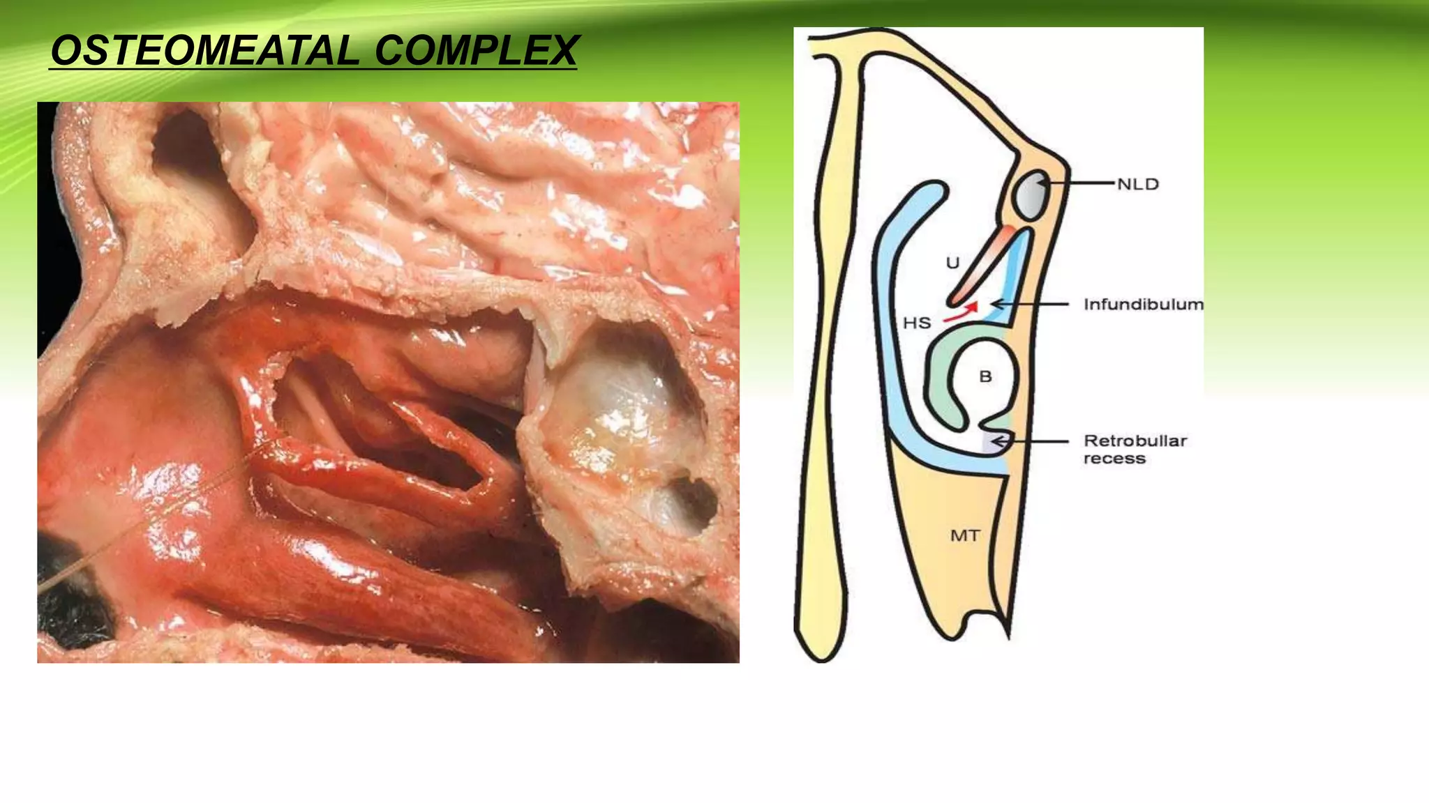 LATERAL WALL OF NOSE.pptx