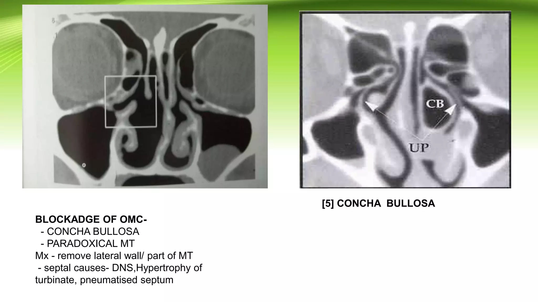LATERAL WALL OF NOSE.pptx