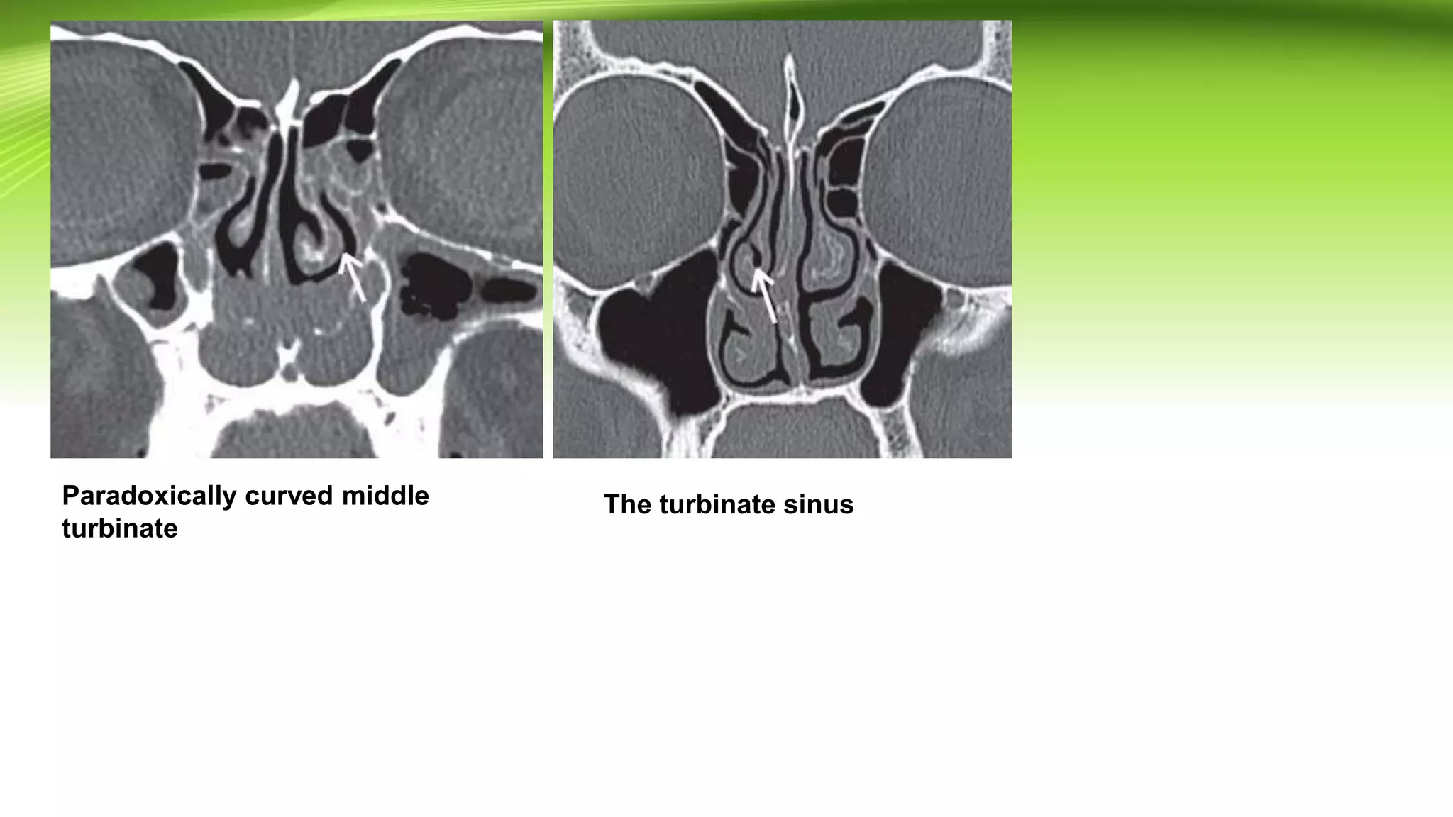 LATERAL WALL OF NOSE.pptx
