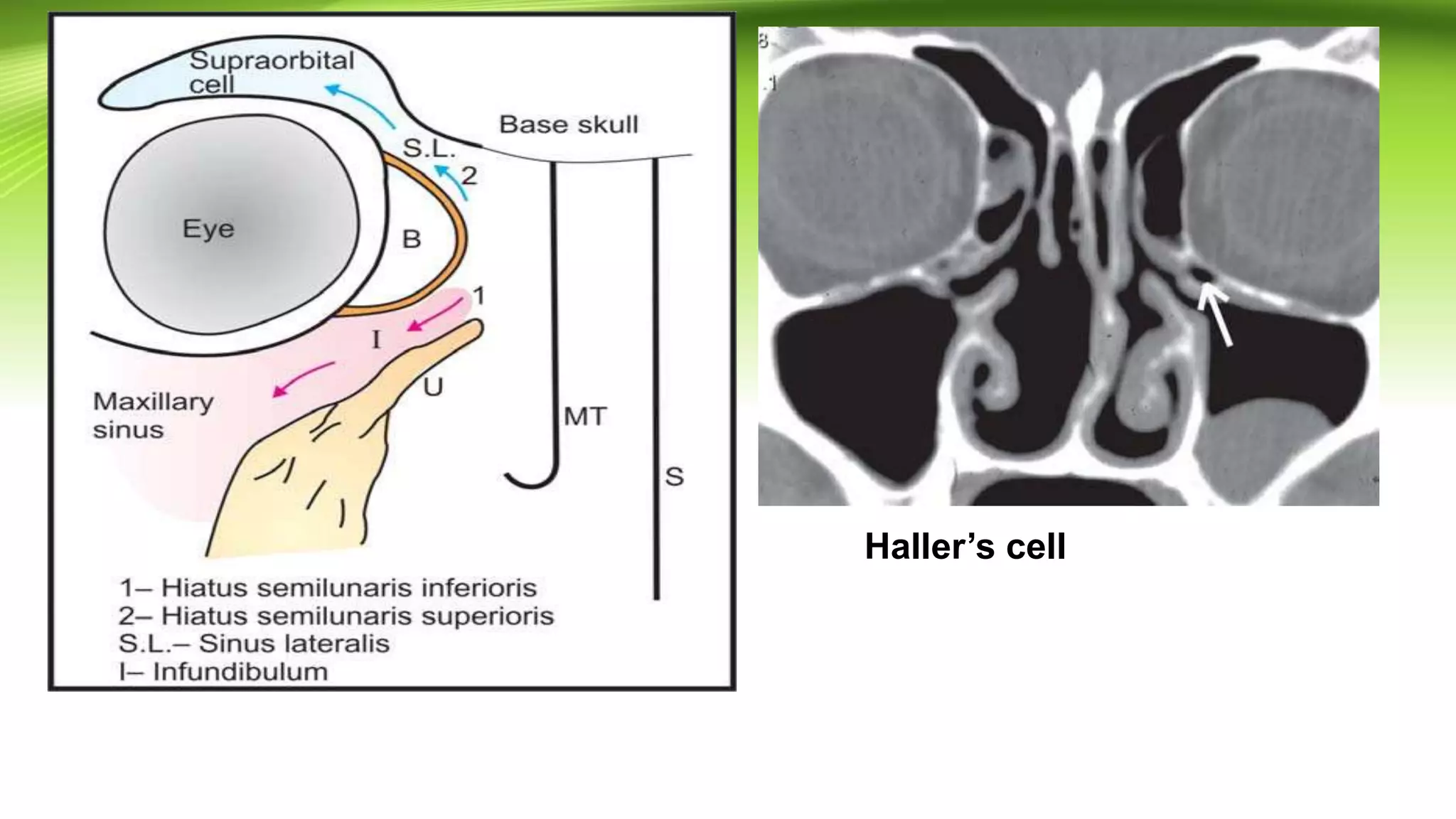 LATERAL WALL OF NOSE.pptx