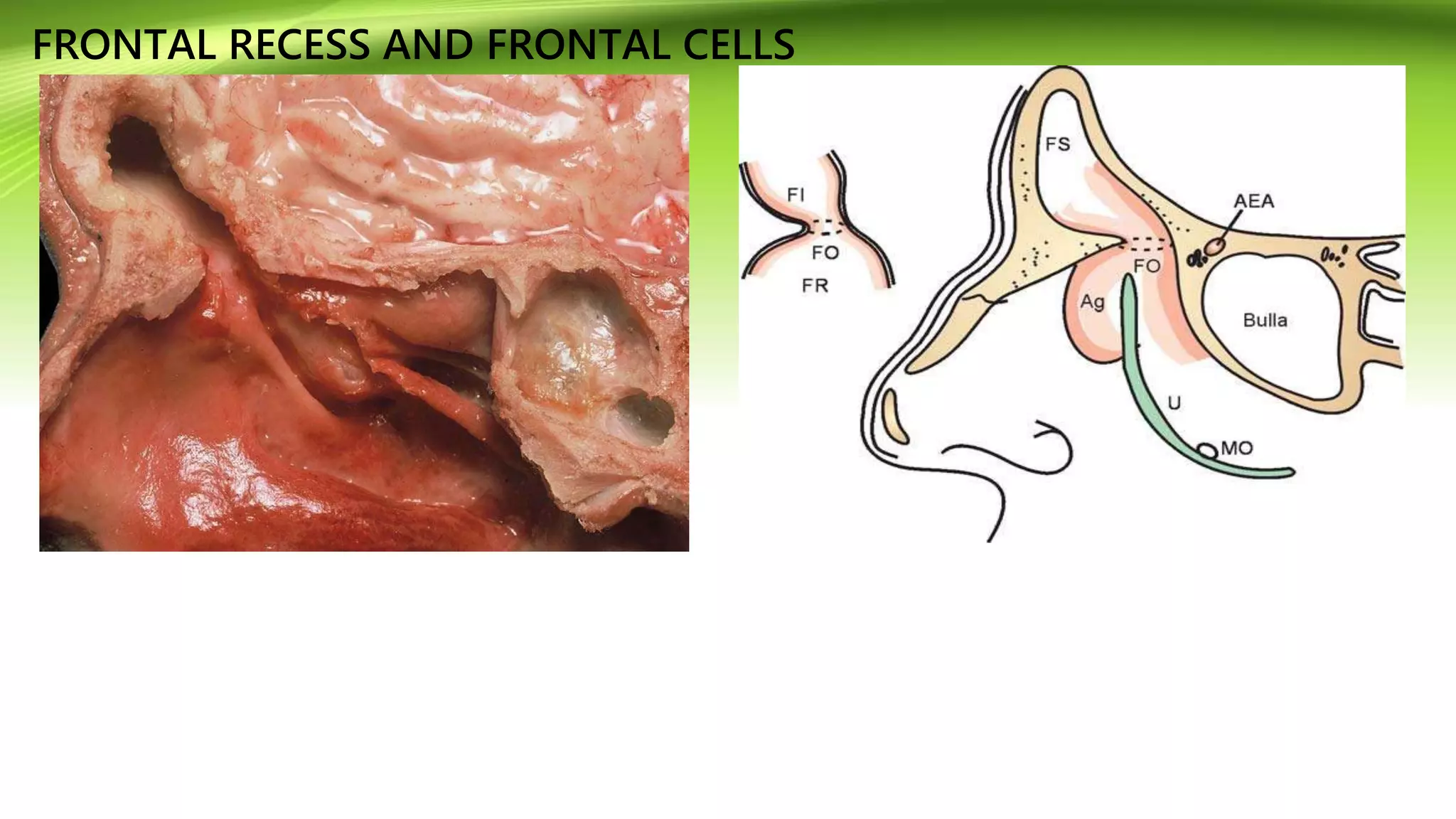 LATERAL WALL OF NOSE.pptx