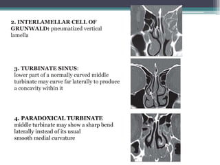 SURGICAL LATERAL WALL OF NOSE (1).ppt