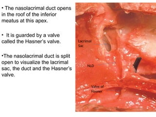 LATERAL WALL OF Nose 2.mckdnejejheijfjpptx | PPTX