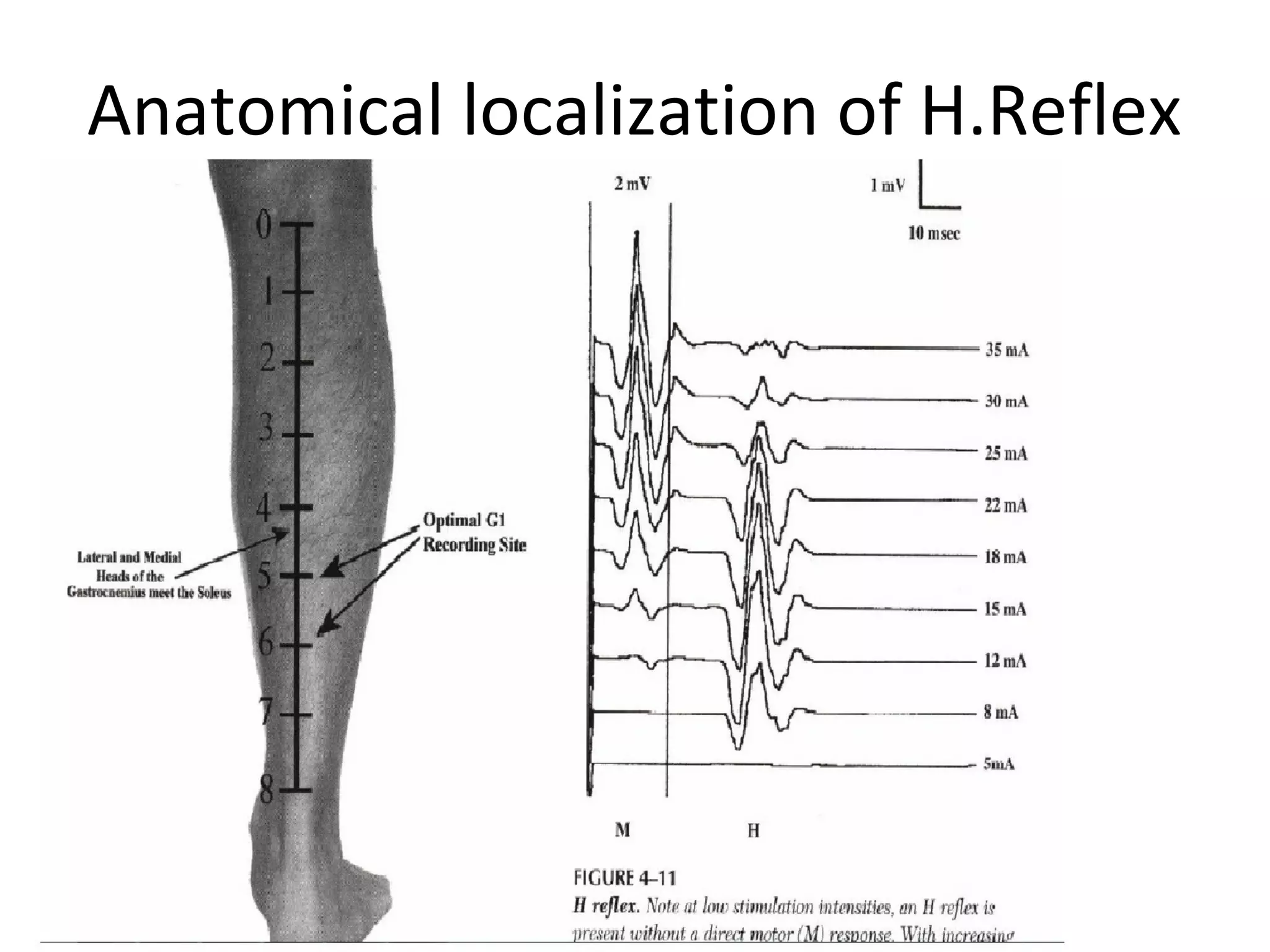 Late Responses (F-wave and H.Reflex) | PPT