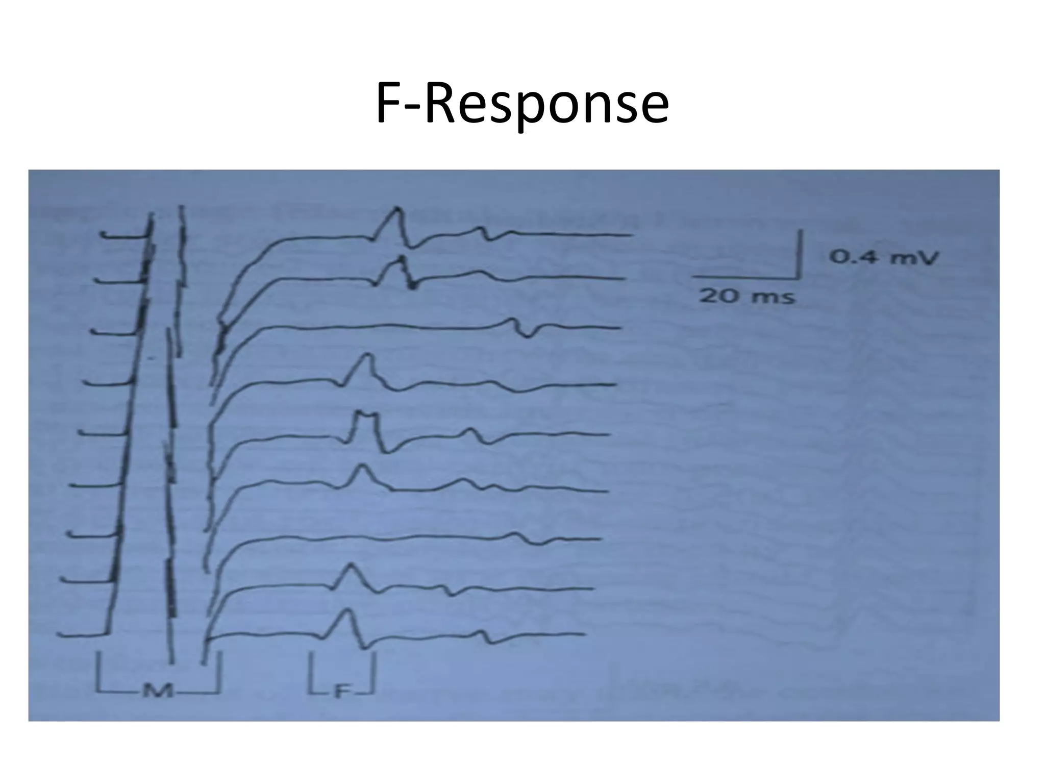 Late Responses (F-wave and H.Reflex) | PPT