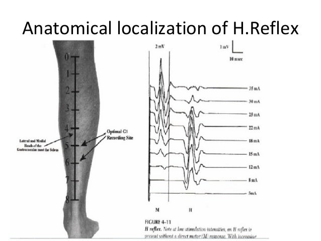 Late Responses (F-wave and H.Reflex)