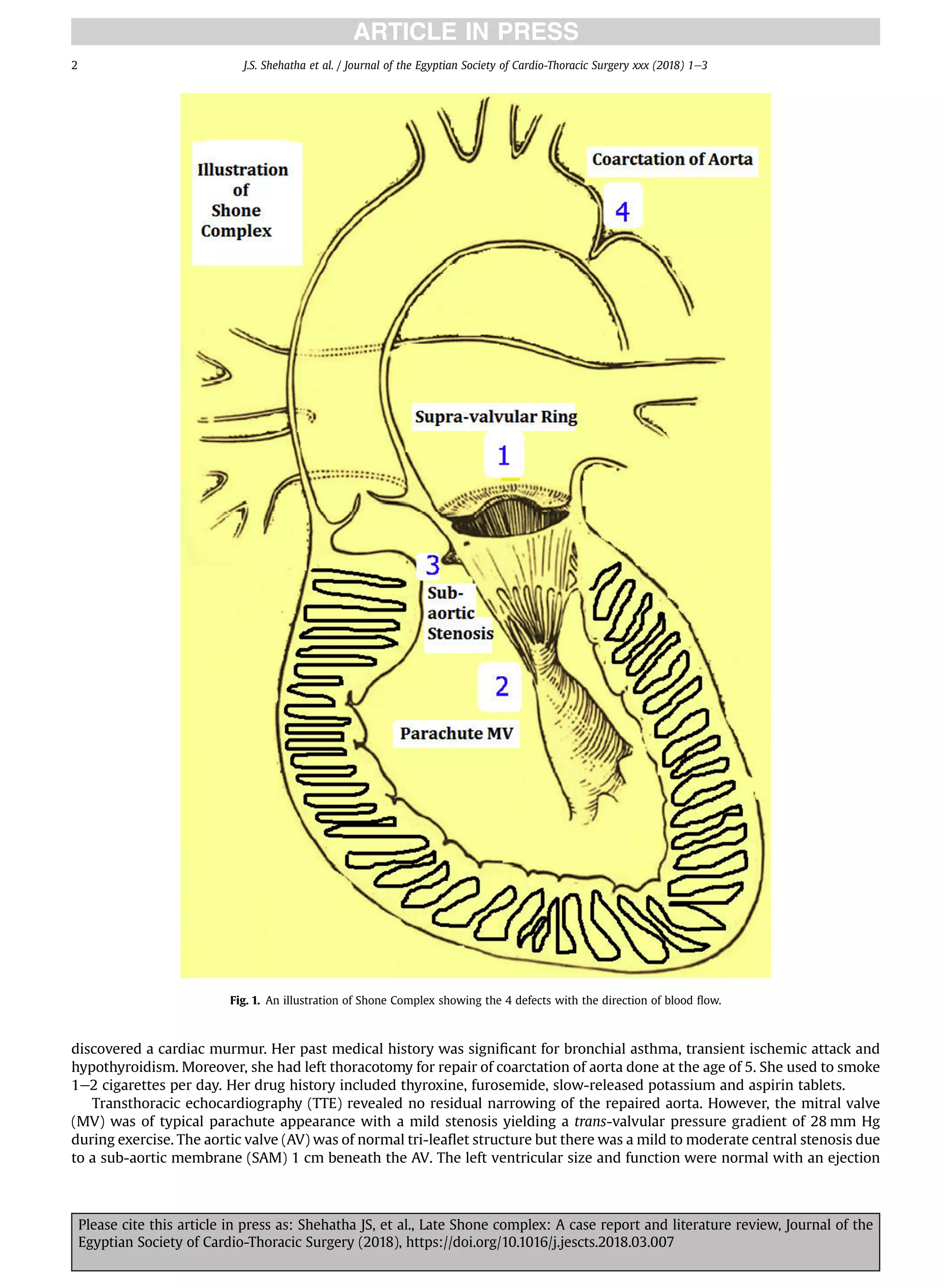 Late shone complex case report and literature review | PDF | Heart and ...