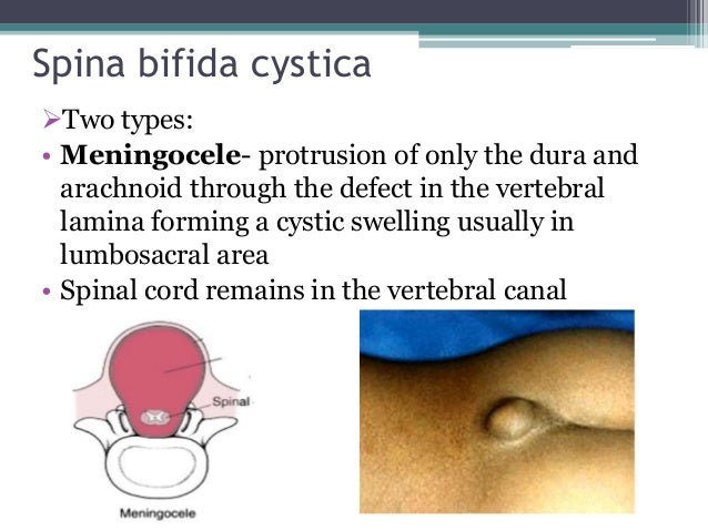 spina bifida