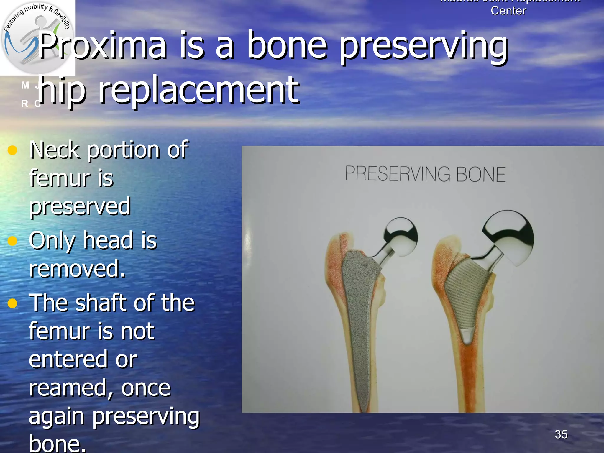 Latest Advances In Joint Replacement & Knee Implant | PPT