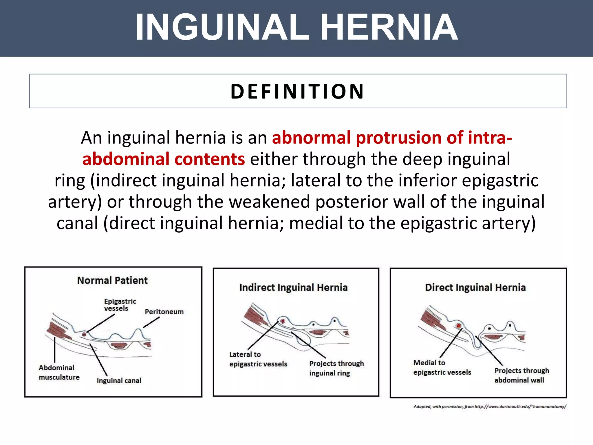 Inguinalscrotal Disease | PPTX