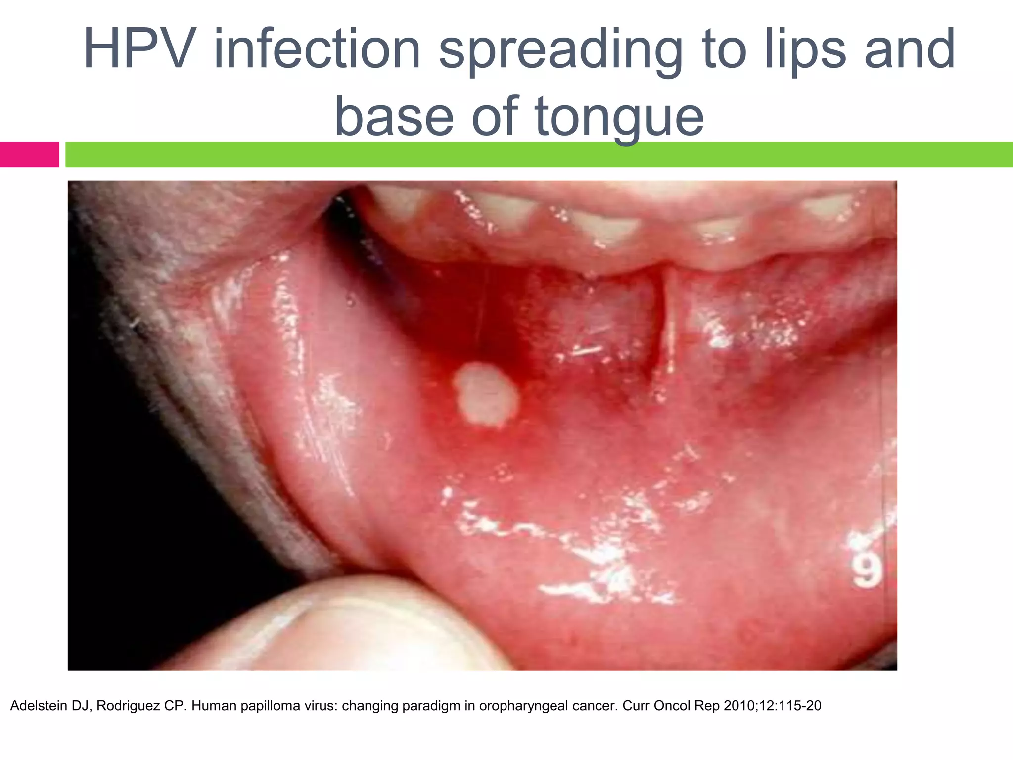 Latest presentation of hpv in head and neck | PPTX