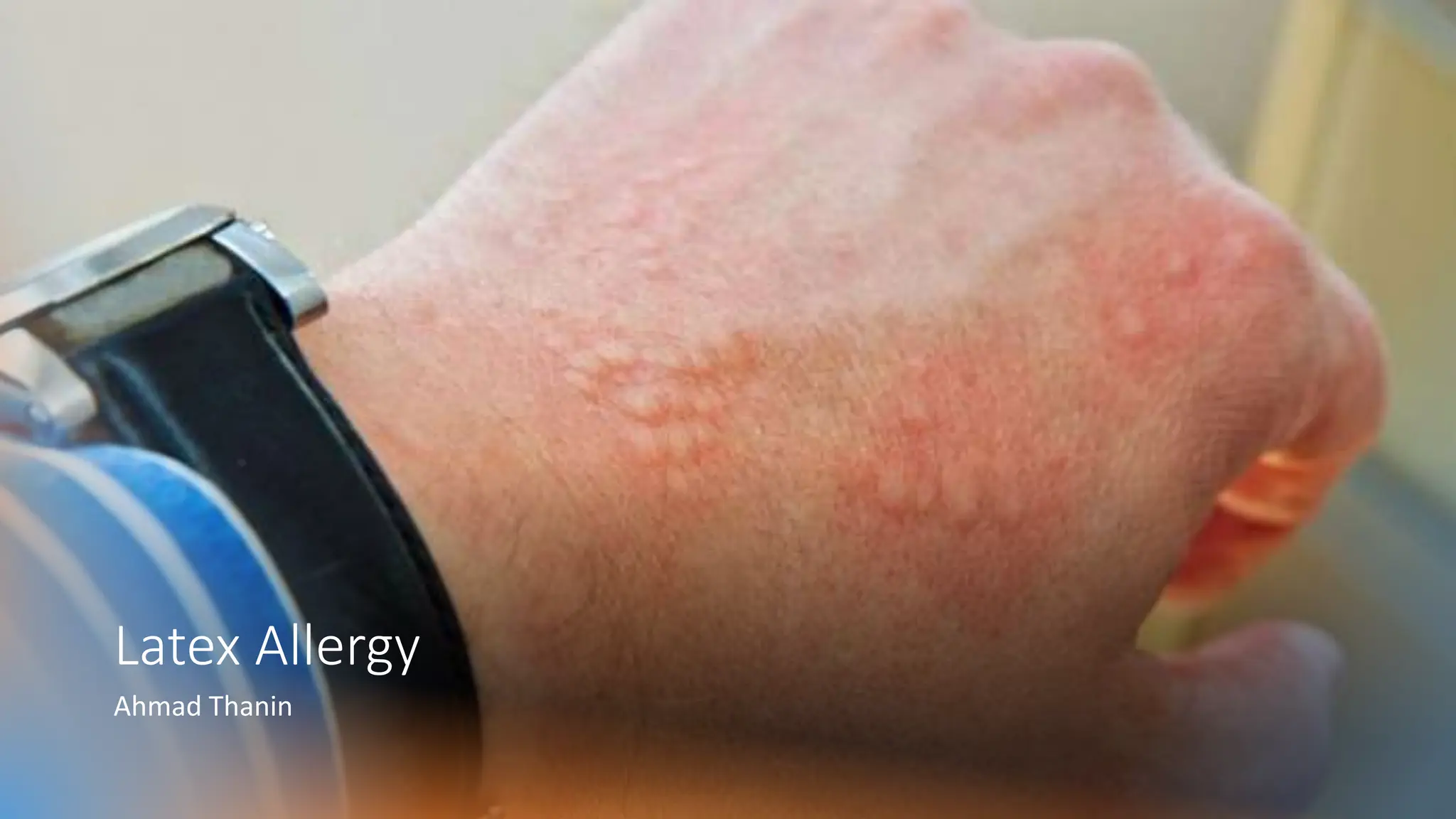 Latex Allergy | PPTX