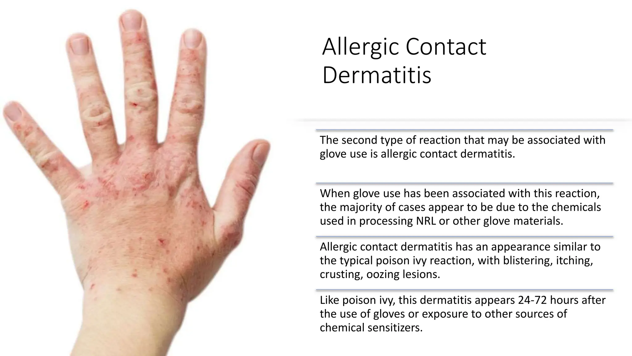 Latex Allergy | PPTX
