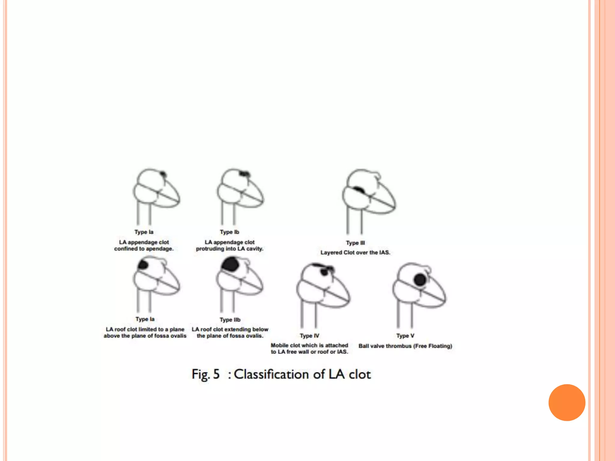 Left Atrial Thrombus - A Review | PPTX | Heart and Cardiovascular ...
