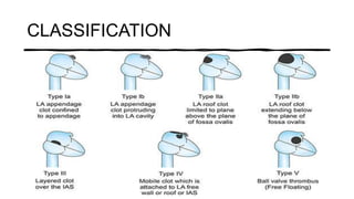 Left atrial thrombus in Echocardiography | PPTX